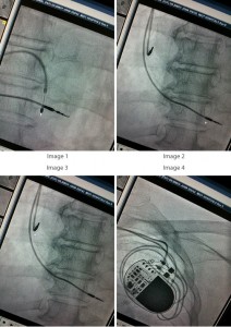 Permanent Pace-maker Implantations (PPI) | MIOT International